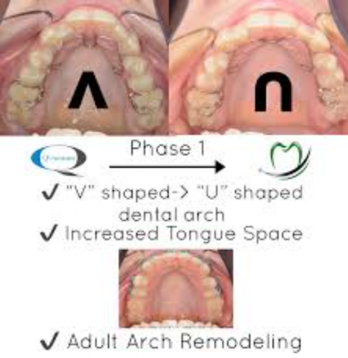 Addressing A Constricted Dental Arch 7994
